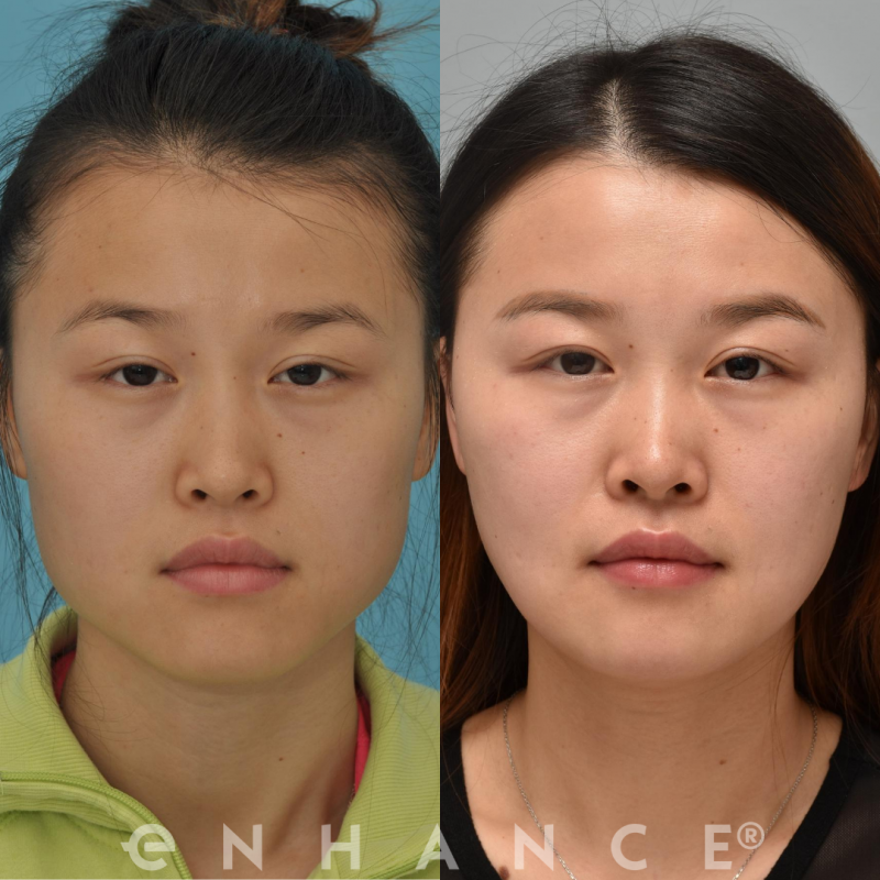 Jaw Reduction Photo Gallery Beverly Hills & West Hollywood